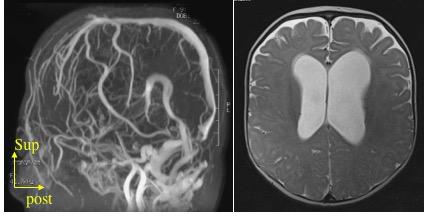 la brachycéphalie – neurochirurgie pédiatrique