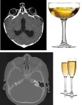 la brachycéphalie – neurochirurgie pédiatrique