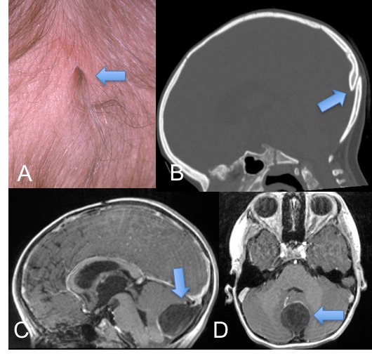 fistules dermiques occipitales – neurochirurgie pédiatrique