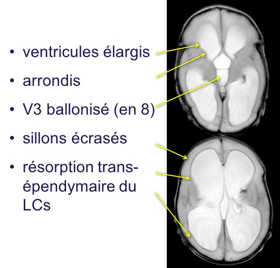 le diagnostic post-natal d’hydrocéphalie – neurochirurgie pédiatrique