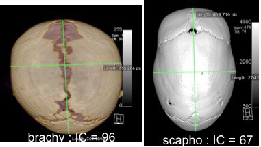 le diagnostic de craniosténose – neurochirurgie pédiatrique