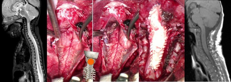 le SCIWORA – neurochirurgie pédiatrique