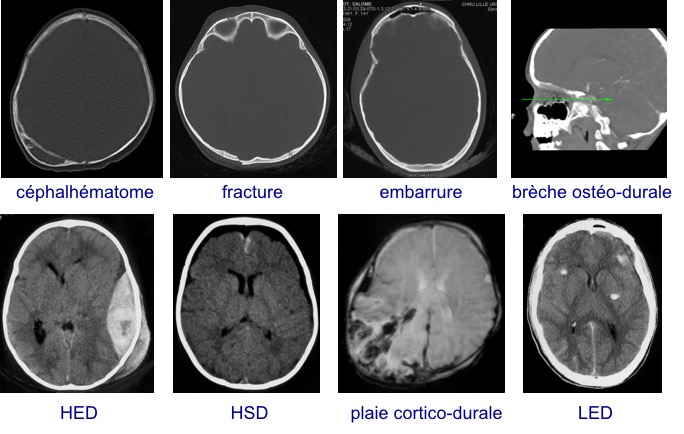 les traumatismes crâniens chez l’enfant – neurochirurgie pédiatrique