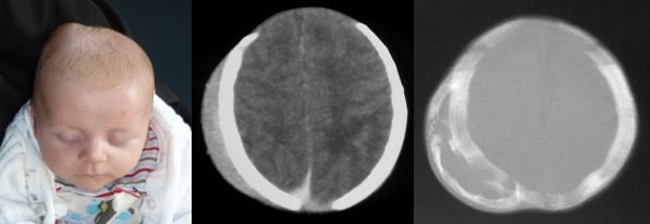le céphalhématome – neurochirurgie pédiatrique