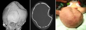 l’embarrure en balle de ping-pong – neurochirurgie pédiatrique