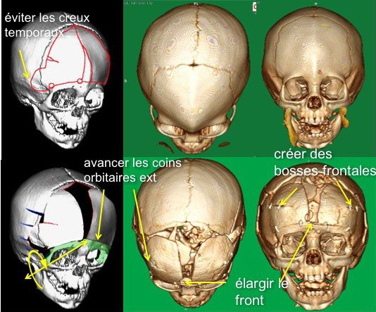 la cranioplastie fronto-orbitaire pour trigonocéphalie – neurochirurgie ...
