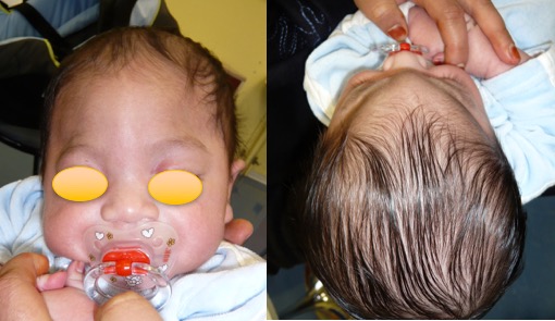 la trigonocéphalie – neurochirurgie pédiatrique