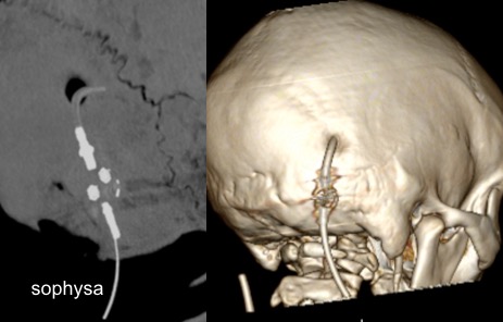 le catalogue des valves – neurochirurgie pédiatrique
