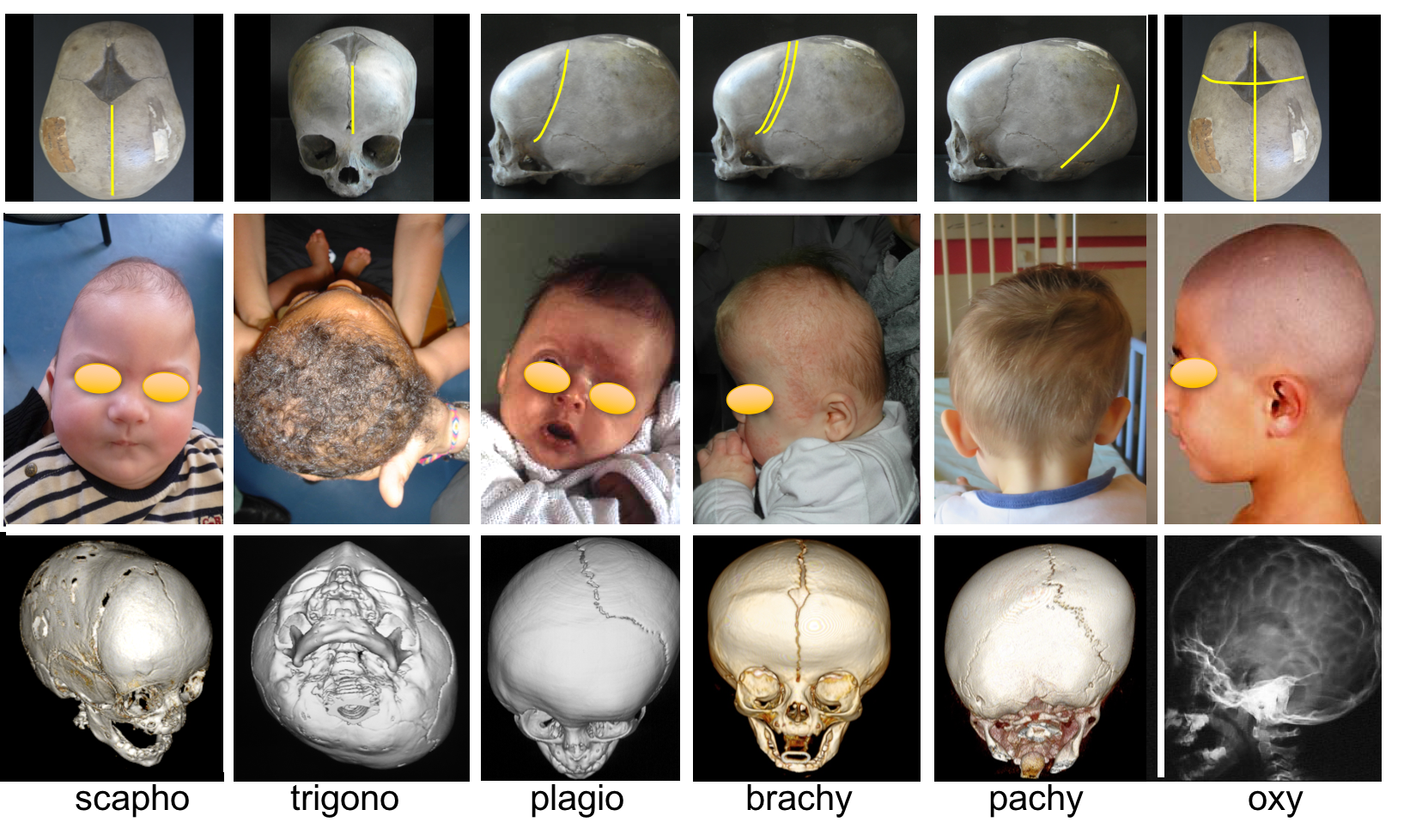 les craniosténoses et craniofaciosténoses – neurochirurgie pédiatrique