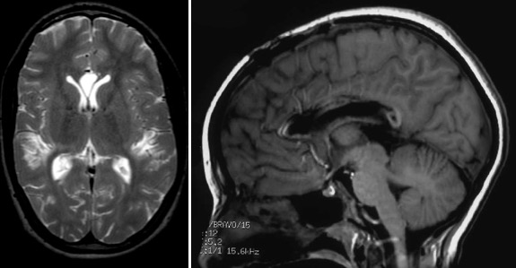 la callosotomie – neurochirurgie pédiatrique