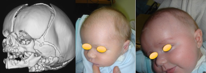 l’embarrure en balle de ping-pong – neurochirurgie pédiatrique