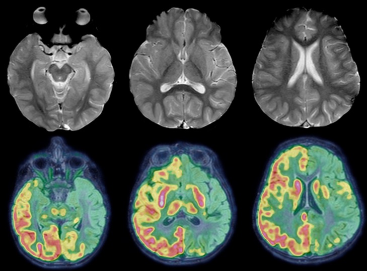 l’hémisphérotomie – neurochirurgie pédiatrique