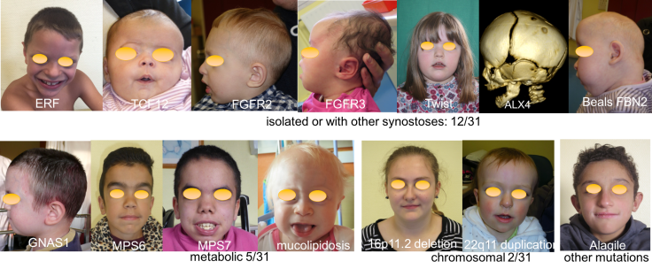la craniosténose de la suture lambdoïde – neurochirurgie pédiatrique