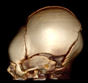 les traumatismes crâniens néo-nataux – neurochirurgie pédiatrique