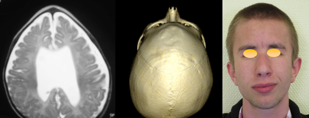 la trigonocéphalie – neurochirurgie pédiatrique