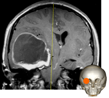 l’engagement – neurochirurgie pédiatrique