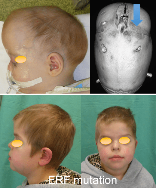nosologie et génétique des craniosténoses – neurochirurgie pédiatrique