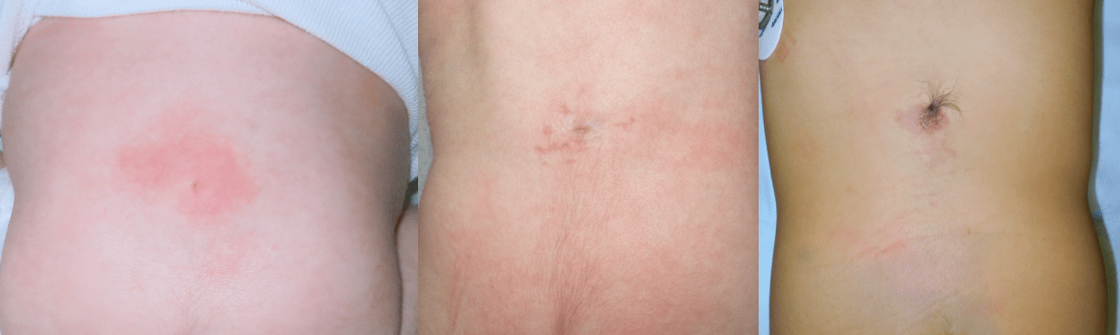 les fistules dermiques spinales – neurochirurgie pédiatrique