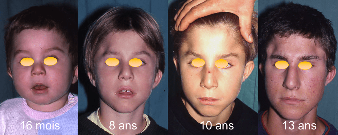 la cranioplastie fronto-orbitaire pour trigonocéphalie – neurochirurgie ...