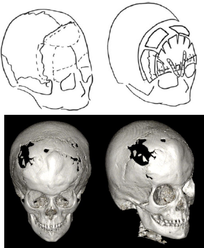 la cranioplastie fronto-orbitaire pour trigonocéphalie – neurochirurgie ...