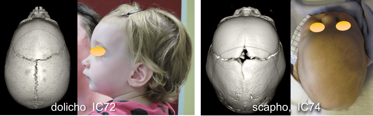 le diagnostic de craniosténose – neurochirurgie pédiatrique