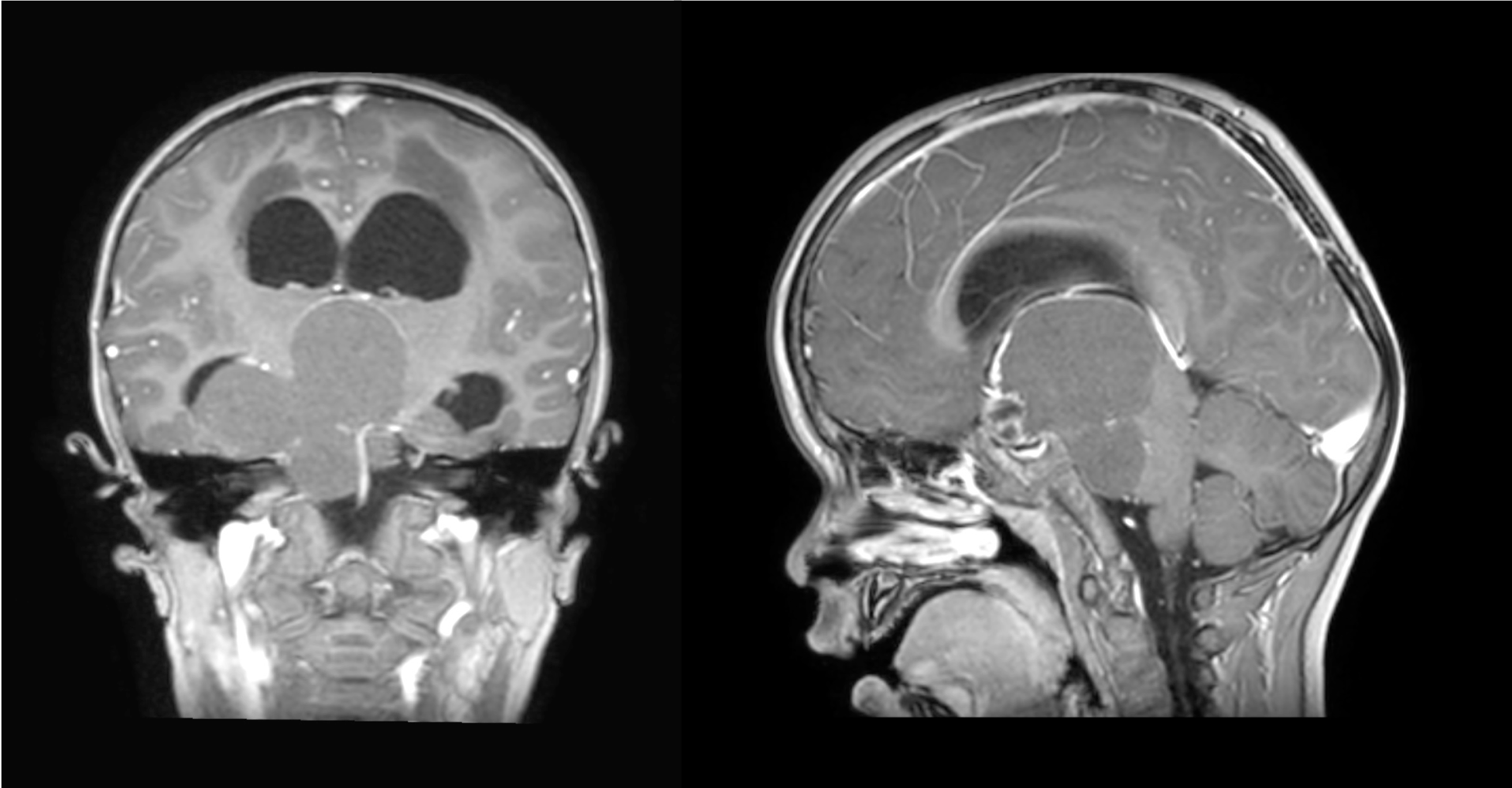 l’endoscopie pour crâniopharyngiome kystique – neurochirurgie pédiatrique